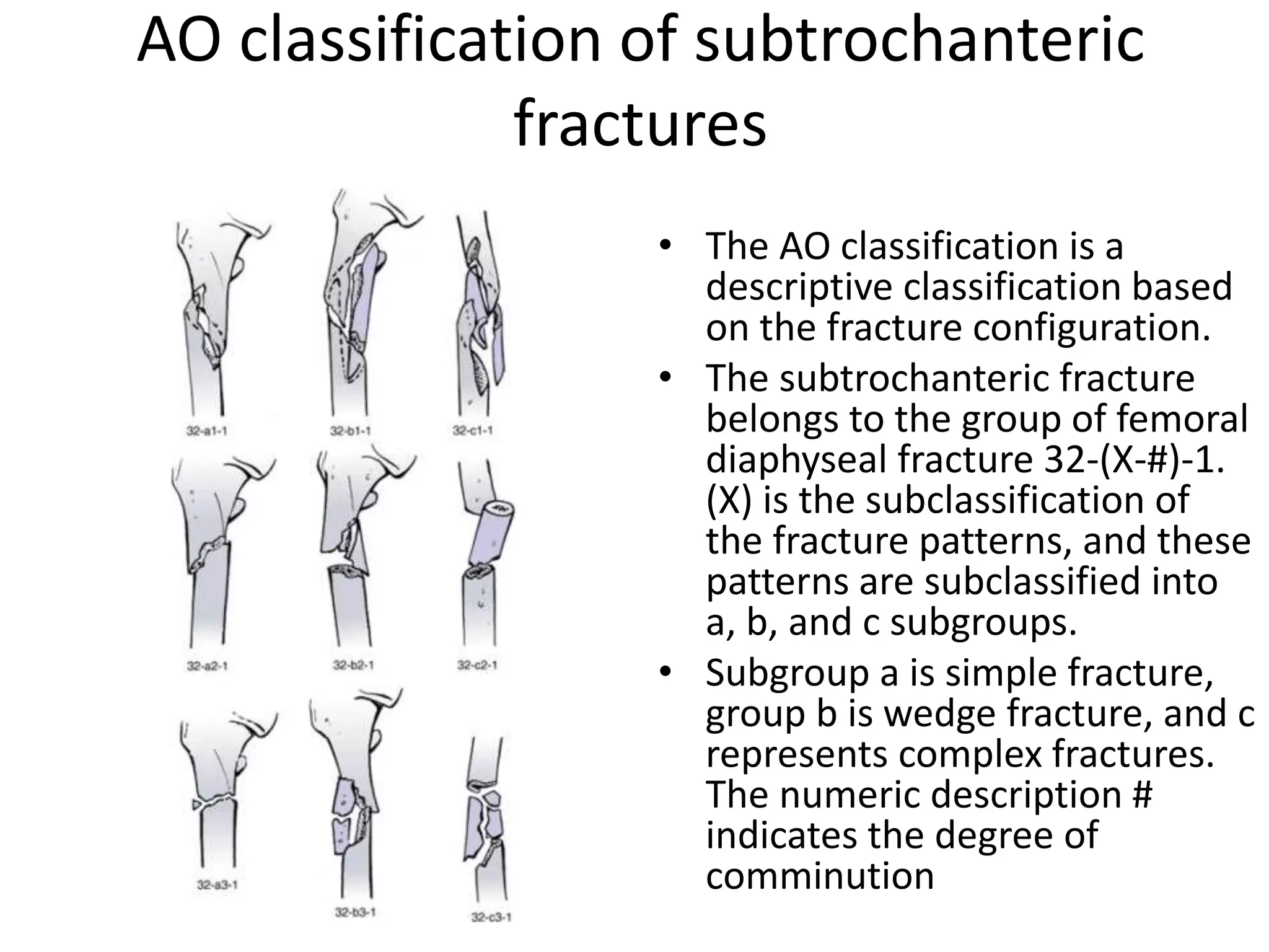 Intertrochanteric & subtrochanteric fracture classification | PPTX