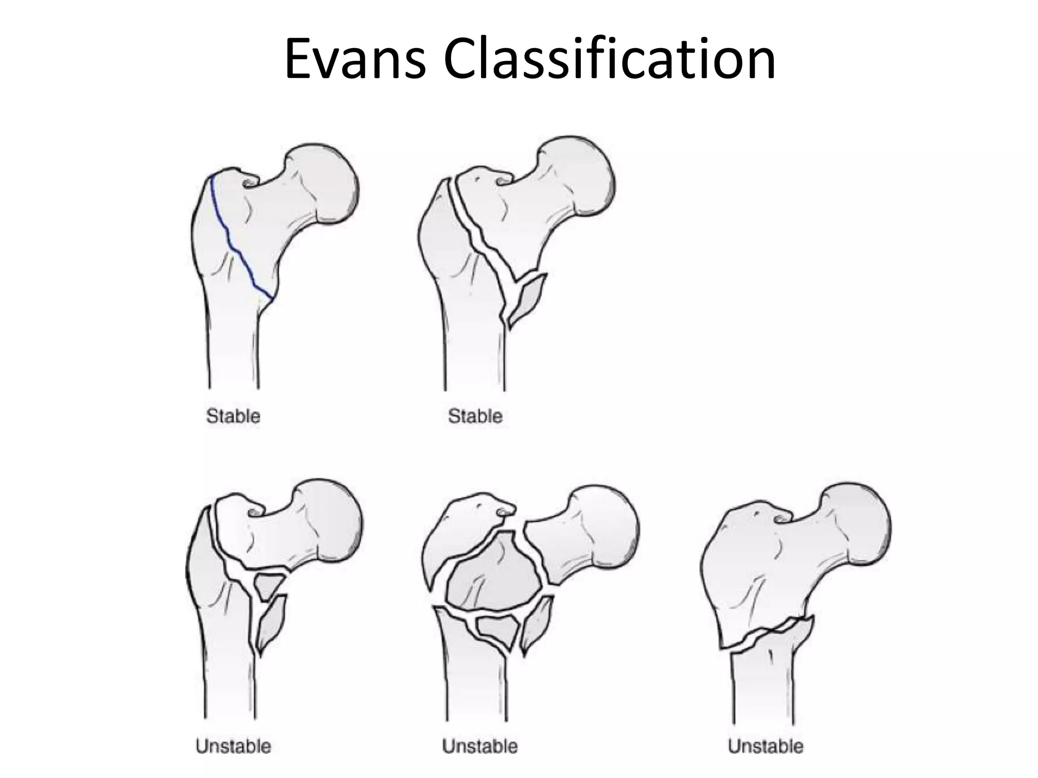 Intertrochanteric & subtrochanteric fracture classification | PPTX
