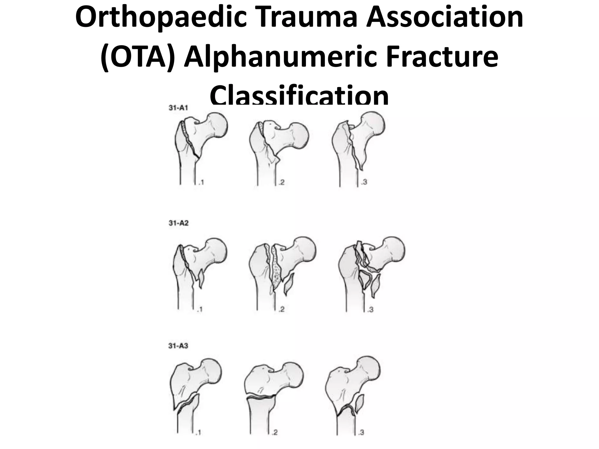 Intertrochanteric & subtrochanteric fracture classification | PPTX