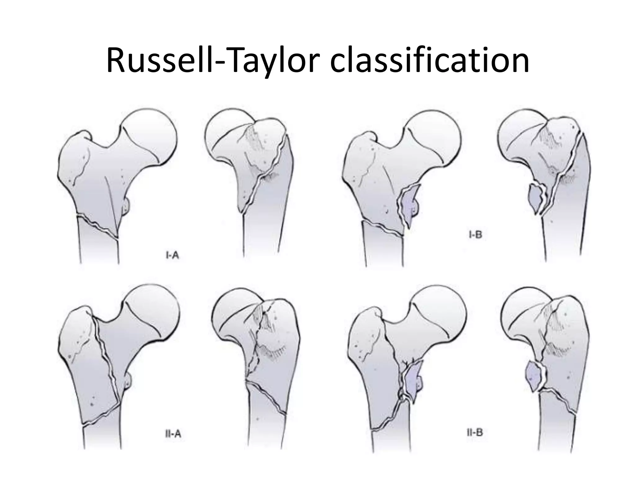Intertrochanteric & subtrochanteric fracture classification | PPTX