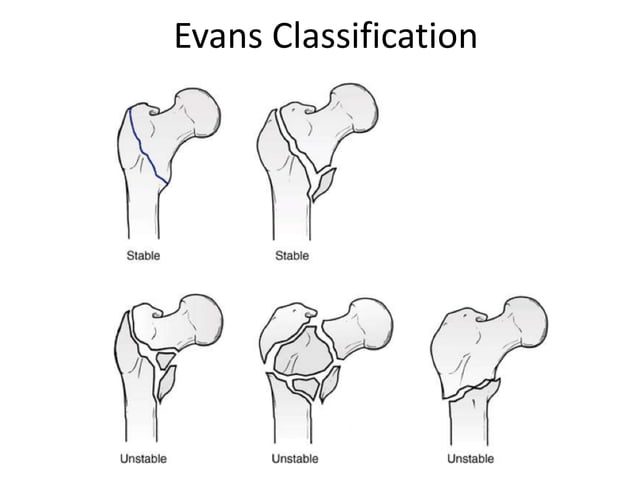 Intertrochanteric & subtrochanteric fracture classification | PPTX
