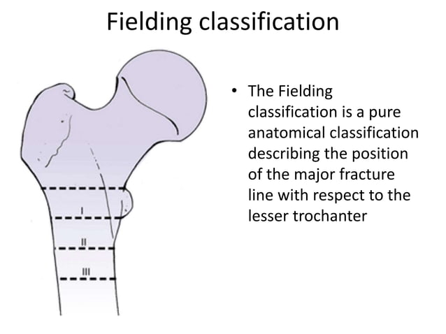 Intertrochanteric & subtrochanteric fracture classification | PPTX