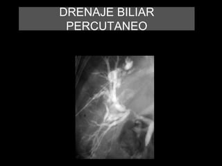 Radiologia Intervencionista de las vias biliares. | PPTX