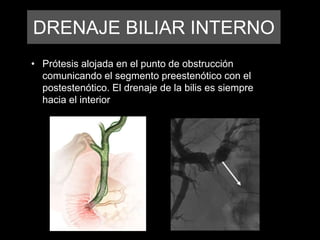 Radiologia Intervencionista de las vias biliares. | PPTX