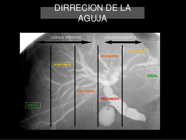 Radiologia Intervencionista de las vias biliares.