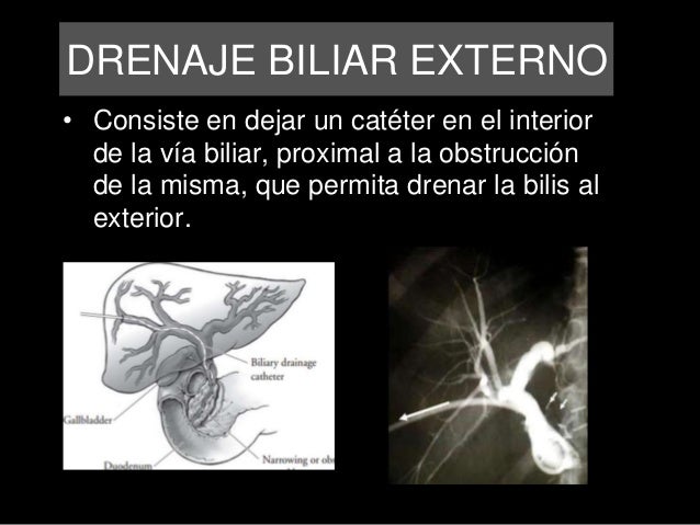Radiologia Intervencionista de las vias biliares.