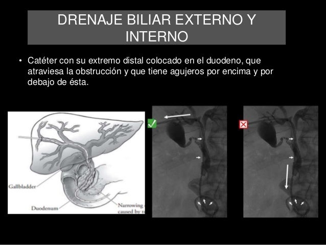 Radiologia Intervencionista de las vias biliares.