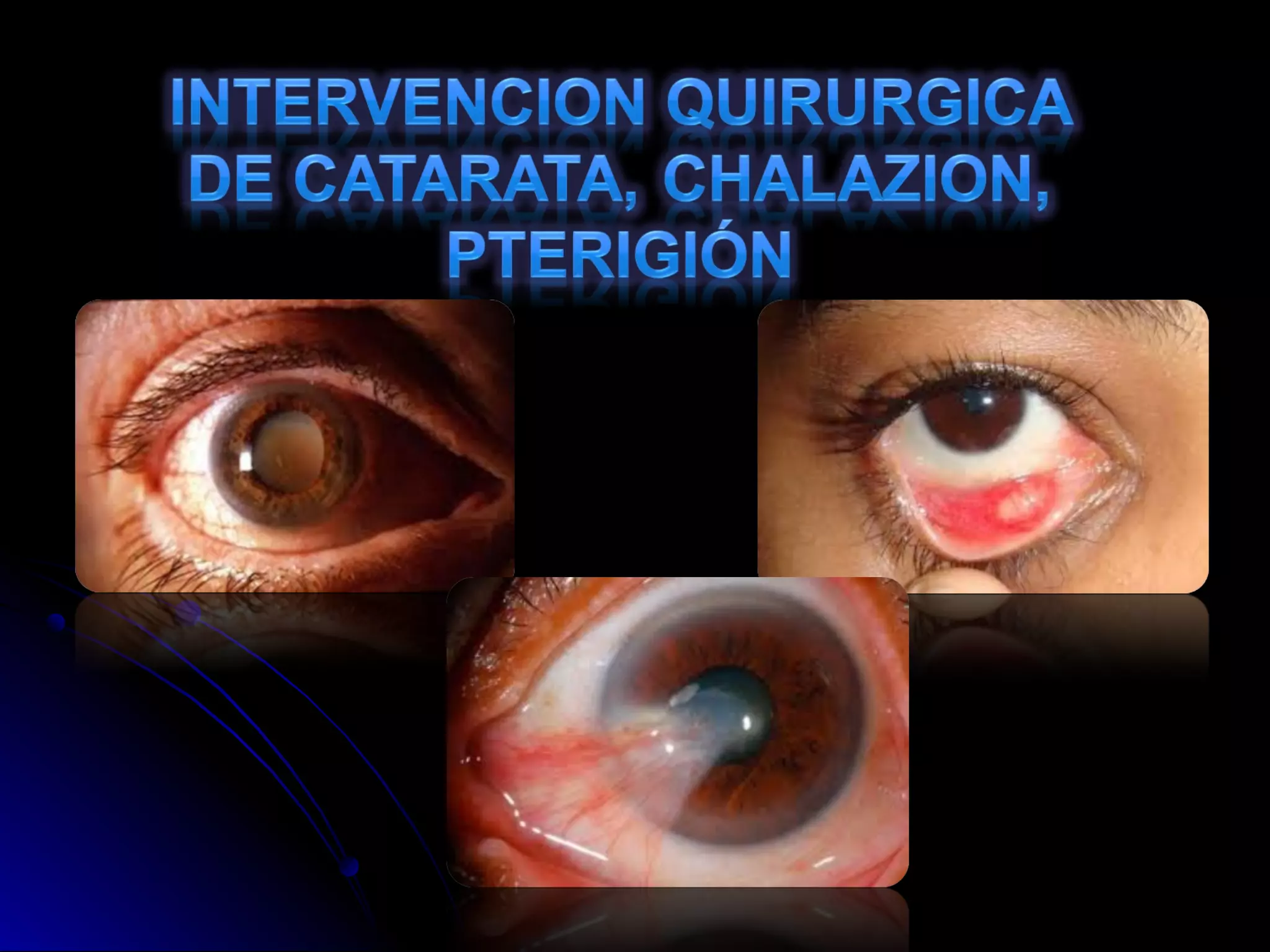 INTERVENCIÓN QUIRURGICA DE CATARATA , CHALAZION , PTERIGIÓN | PPT