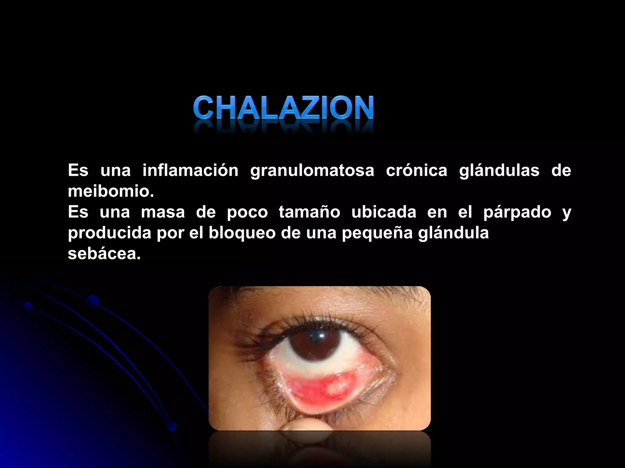 INTERVENCIÓN QUIRURGICA DE CATARATA , CHALAZION , PTERIGIÓN | PPT