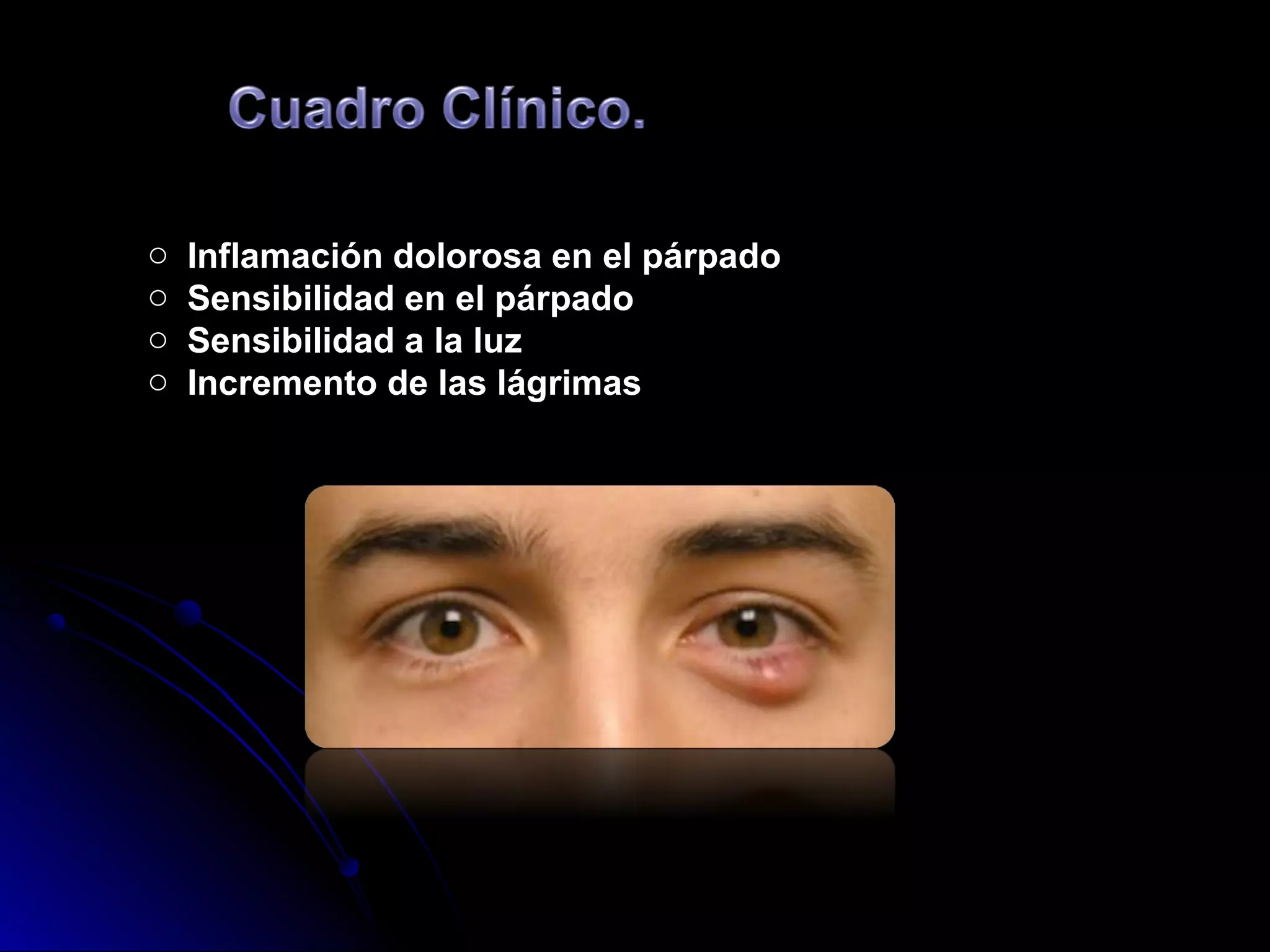 INTERVENCIÓN QUIRURGICA DE CATARATA , CHALAZION , PTERIGIÓN | PPT