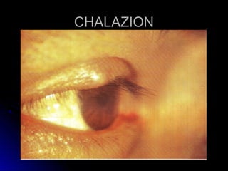 INTERVENCIÓN QUIRURGICA DE CATARATA , CHALAZION , PTERIGIÓN | PPT