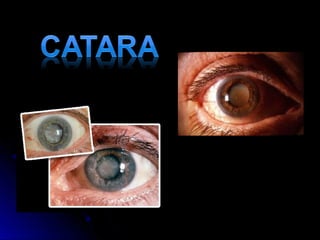INTERVENCIÓN QUIRURGICA DE CATARATA , CHALAZION , PTERIGIÓN | PPT