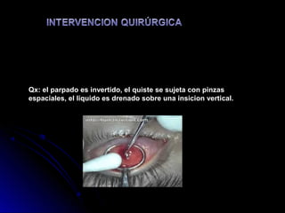 INTERVENCIÓN QUIRURGICA DE CATARATA , CHALAZION , PTERIGIÓN | PPT