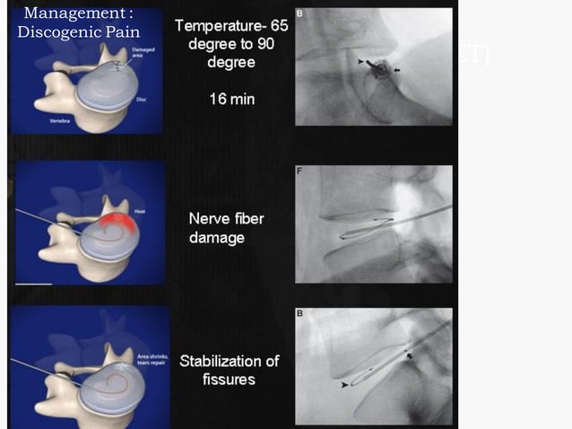 Interventional pain management | PDF