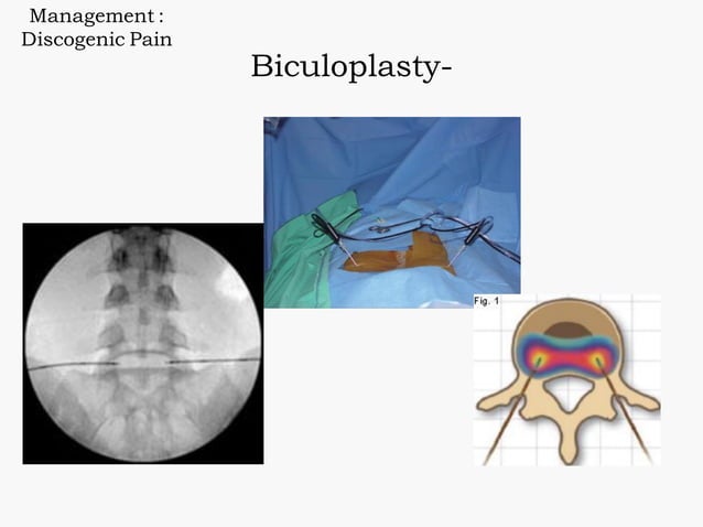 Interventional pain management | PDF
