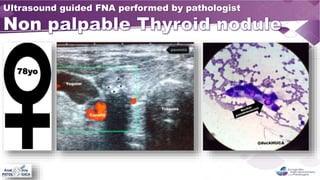 Interventional pathologist Ultrasound guided fna performed by ...