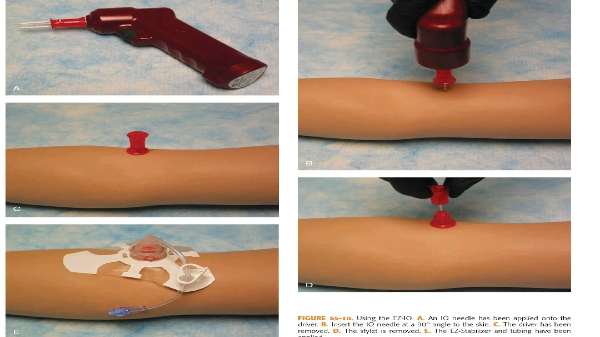 INTERVENTIONAL PROCEDURE IN CHILDREN.pptx
