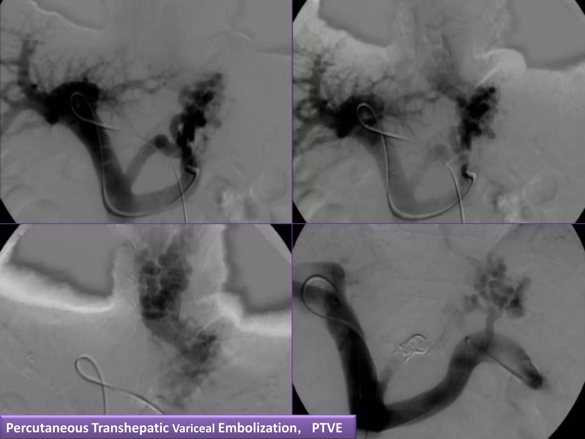 Interventional radiology in the management of gastrointestinal bleeding ...