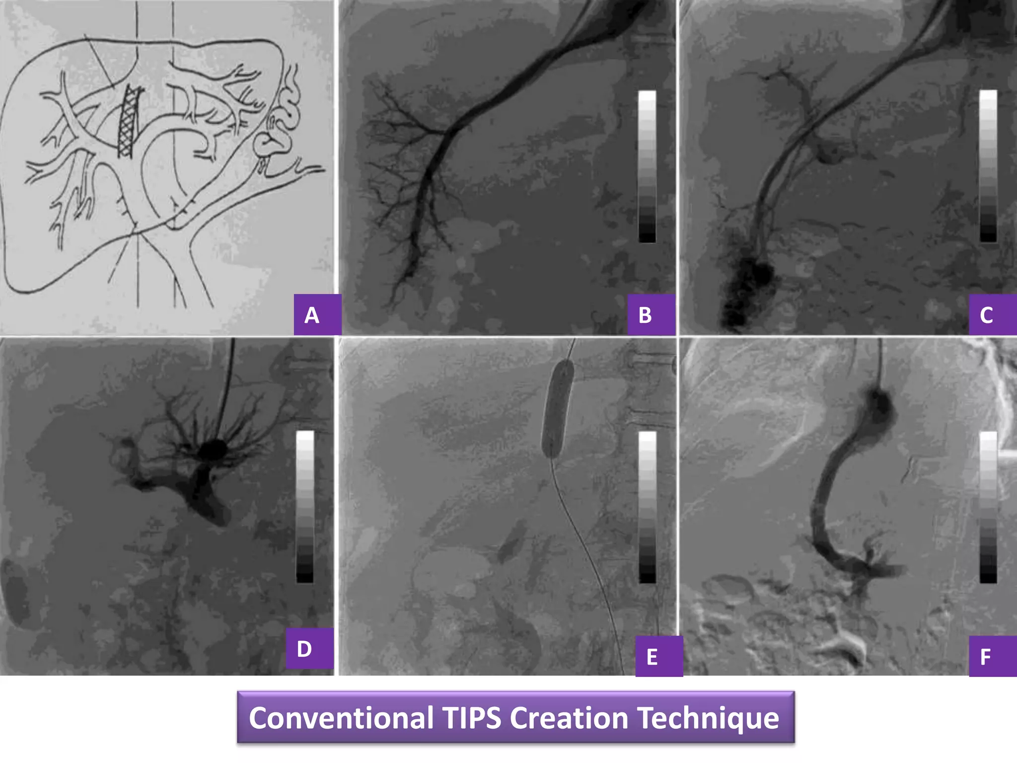 Interventional radiology in the management of gastrointestinal bleeding ...