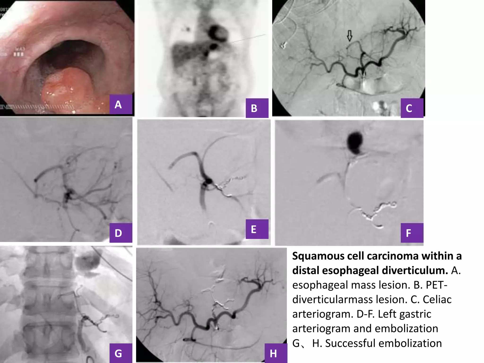 Interventional radiology in the management of gastrointestinal bleeding ...