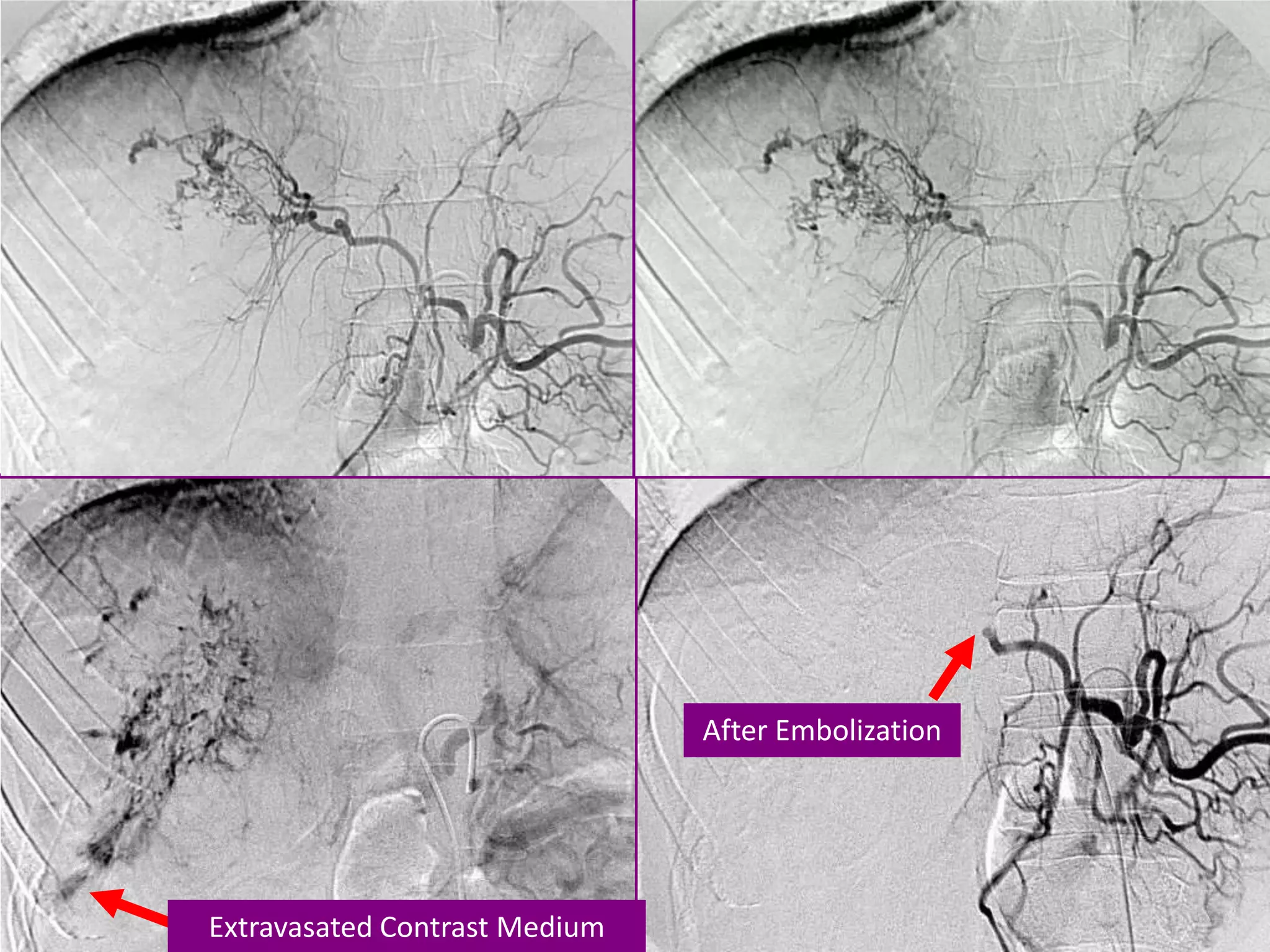 Interventional radiology in the management of gastrointestinal bleeding ...