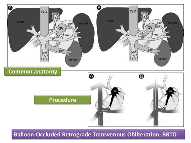 Interventional radiology in the management of gastrointestinal bleedi…