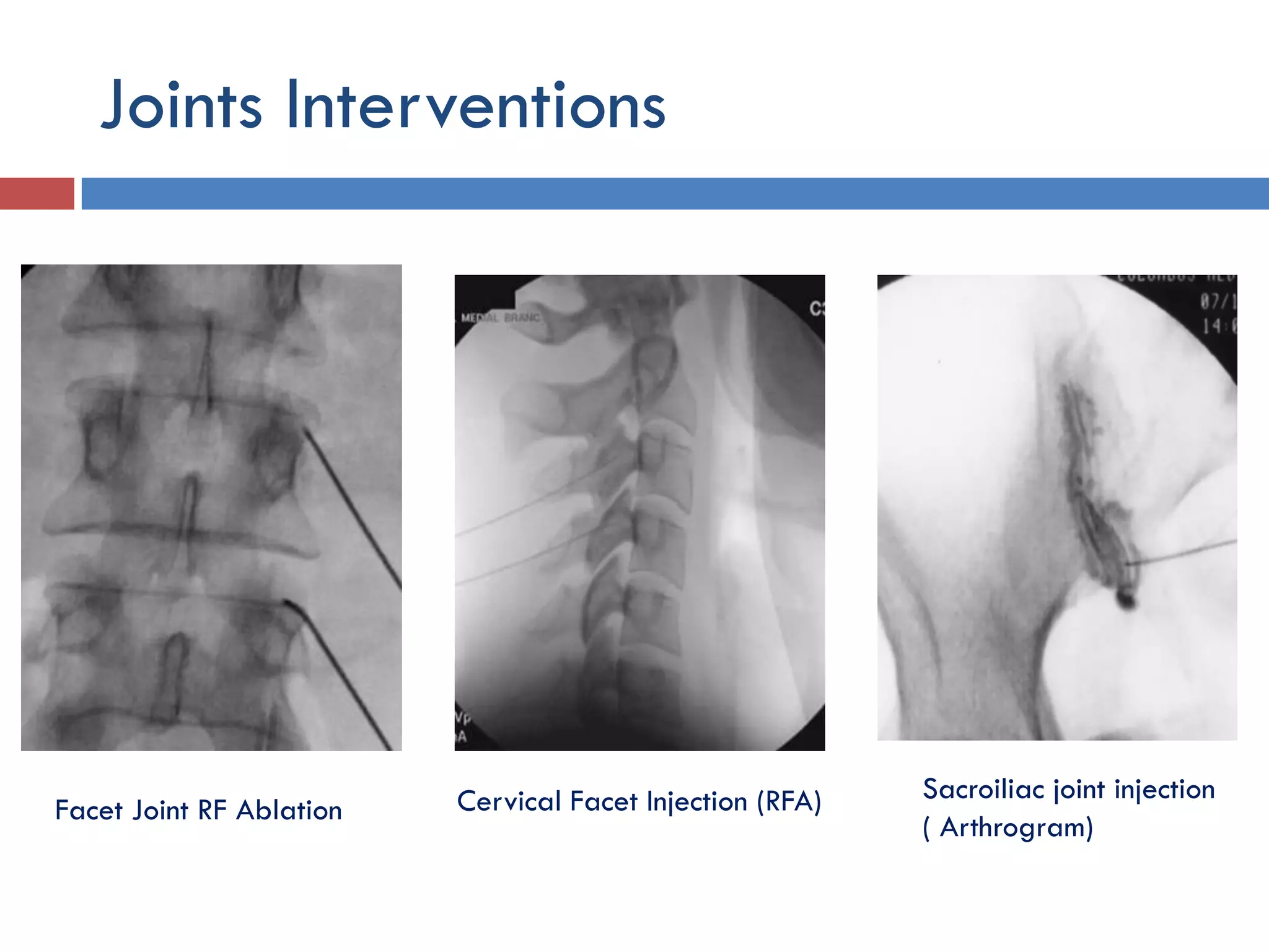 Interventional spine & pain management dr manish raj | PDF