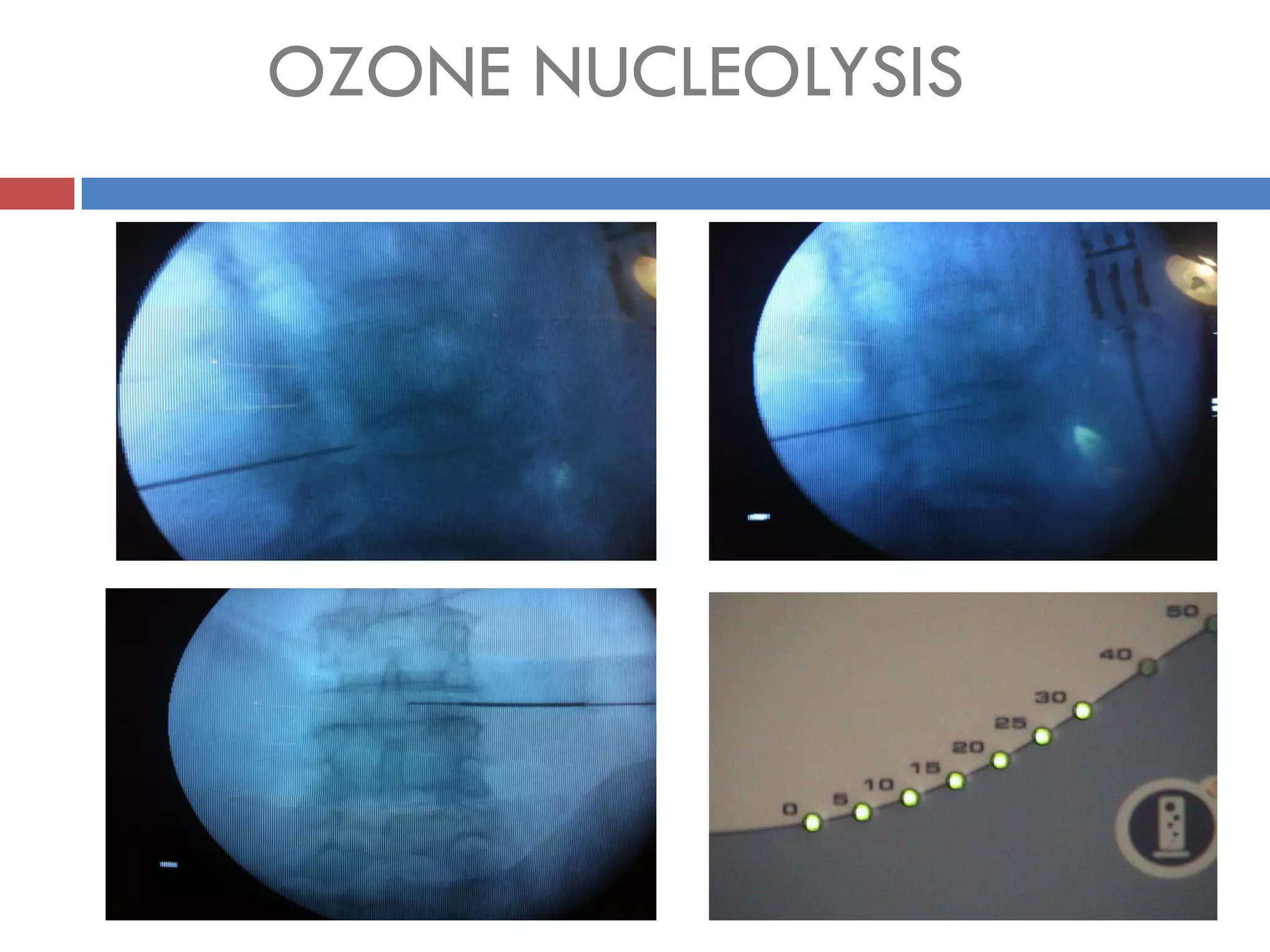 Interventional spine & pain management dr manish raj | PDF