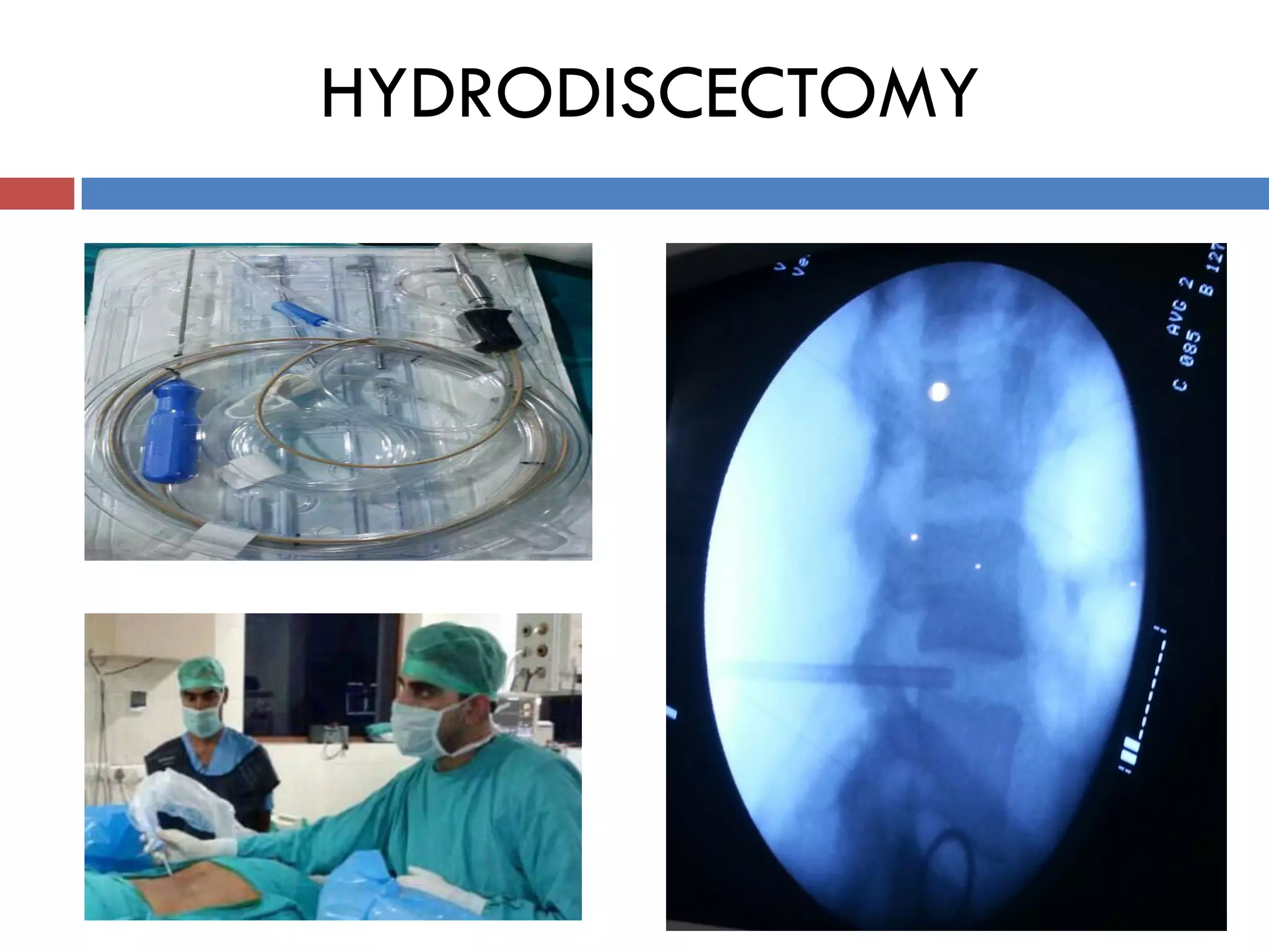 Interventional spine & pain management dr manish raj | PDF