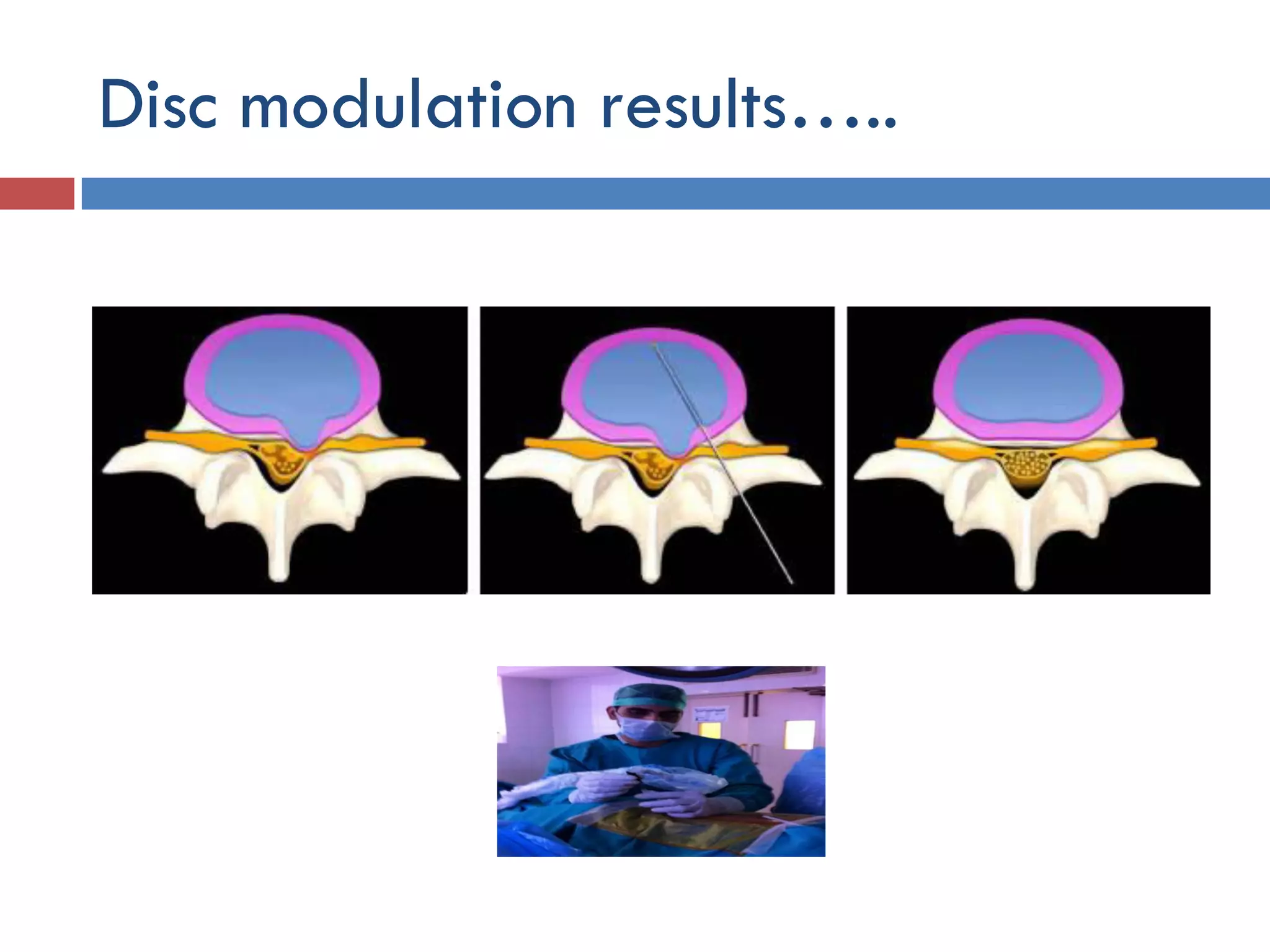 Interventional spine & pain management dr manish raj | PDF