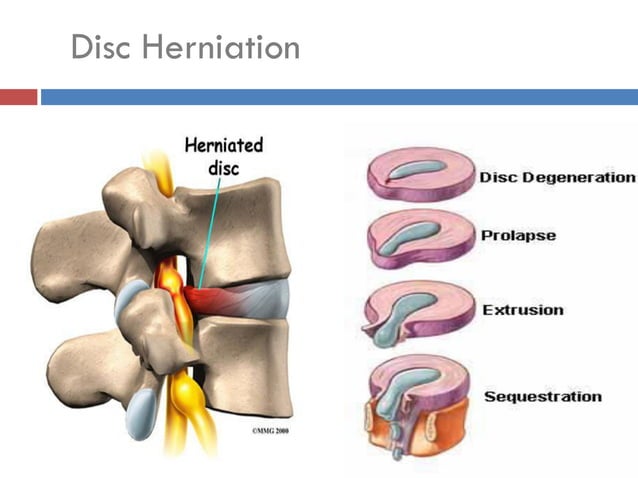 Interventional spine & pain management dr manish raj | PPT