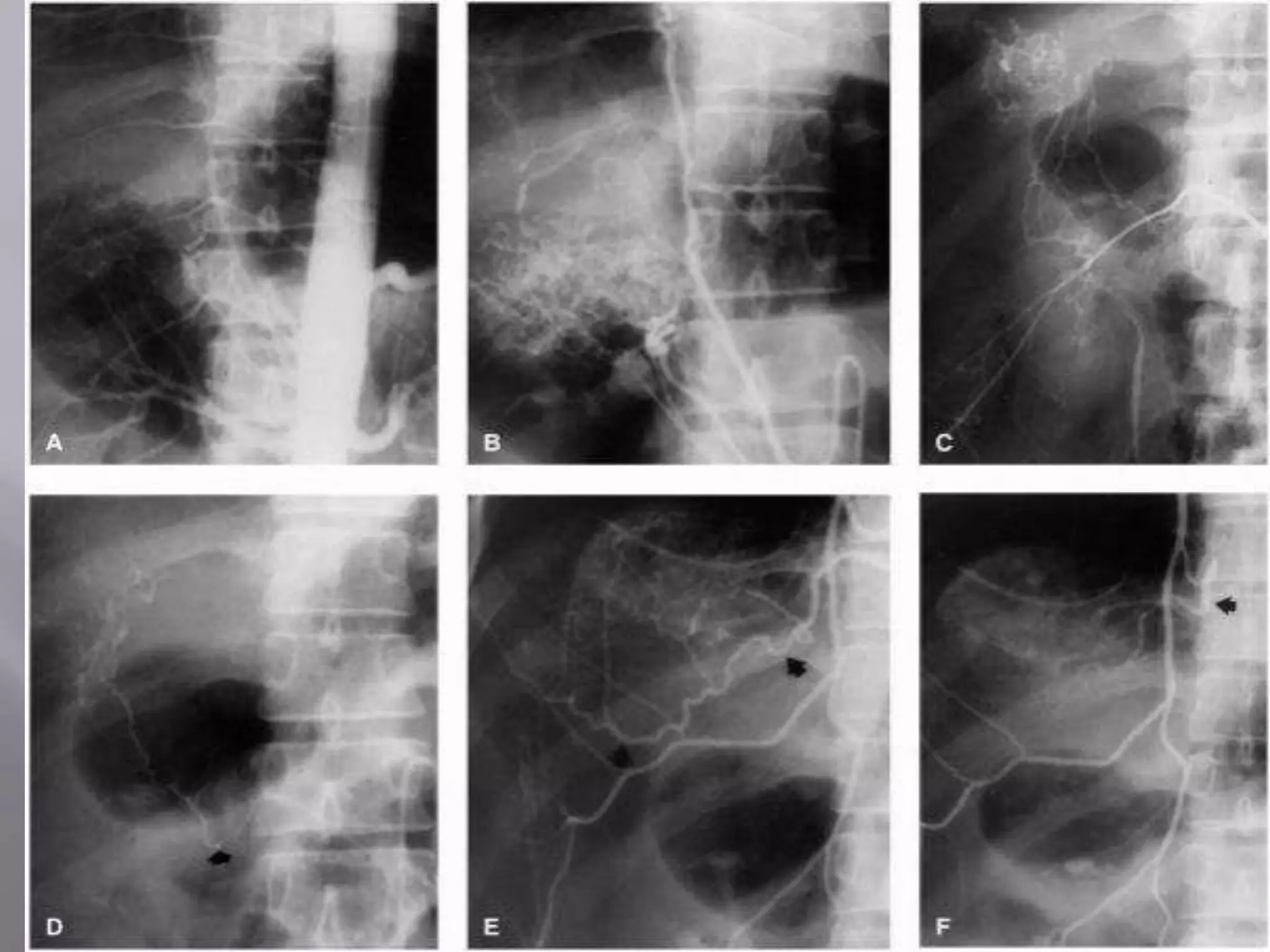 Intervention radiology hepatobiliary system | PPTX