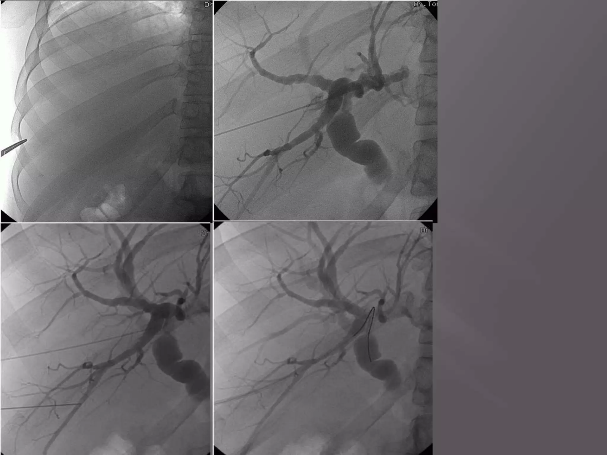Intervention radiology hepatobiliary system | PPTX