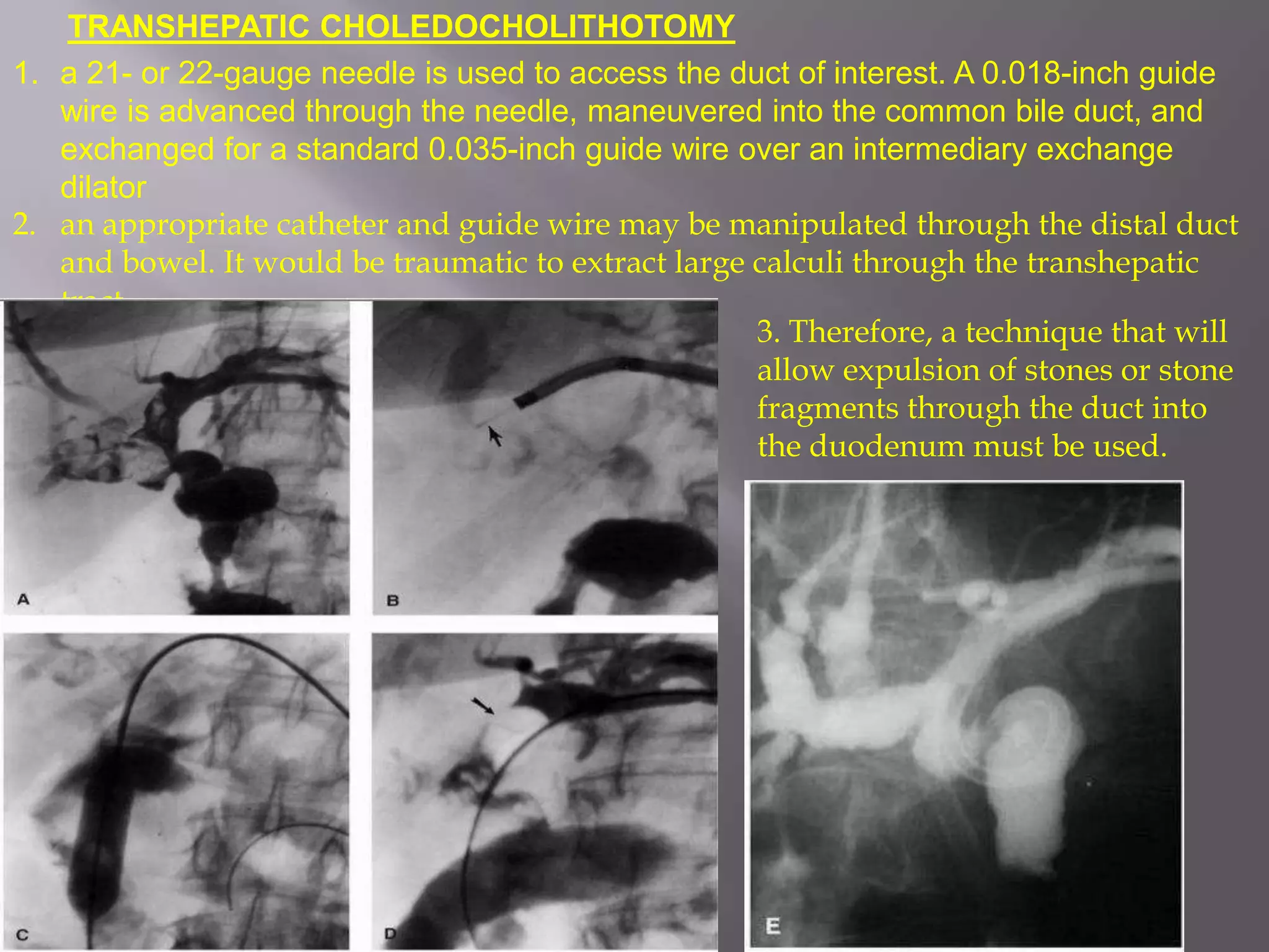 Intervention radiology hepatobiliary system | PPTX