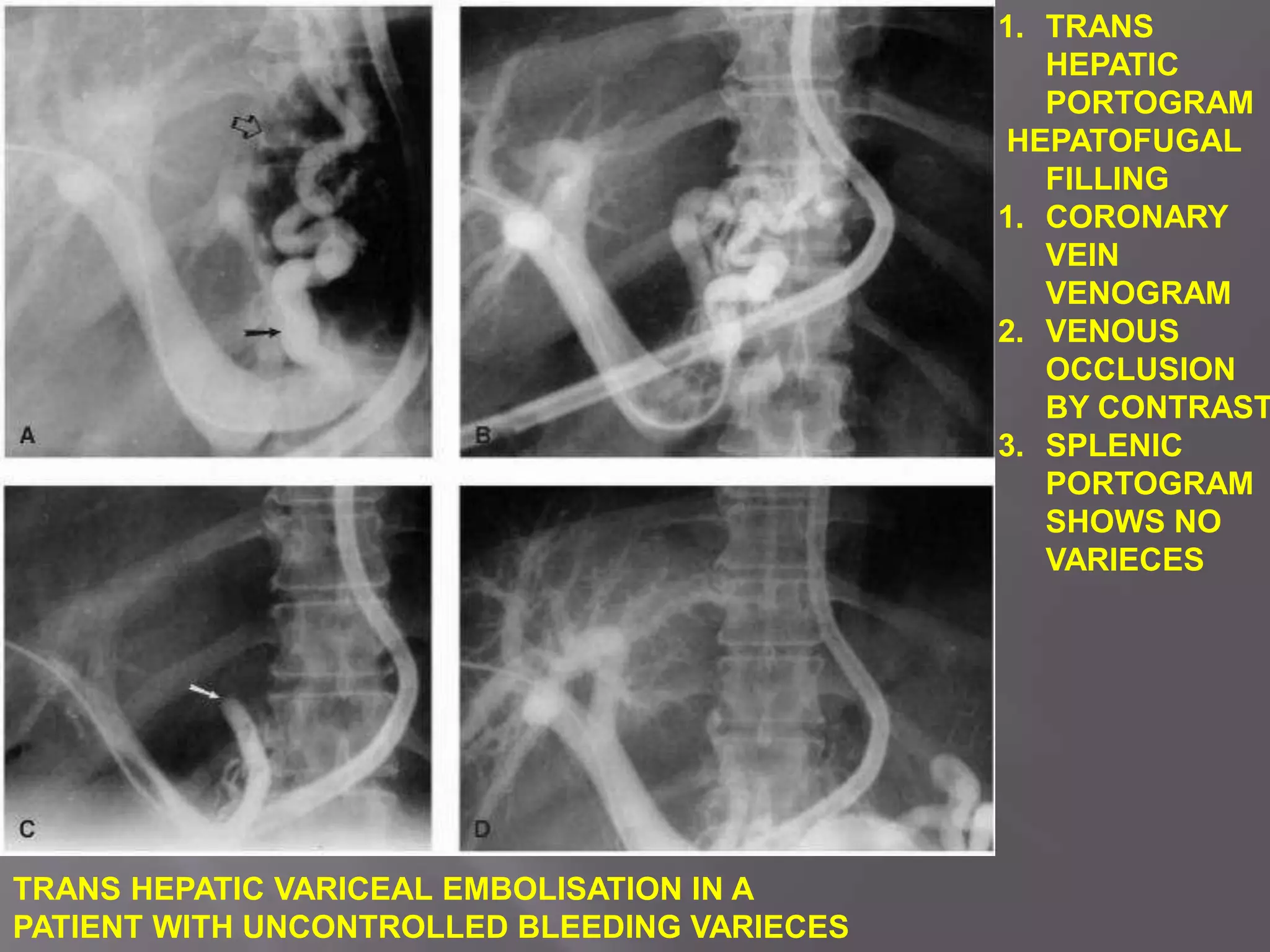 Intervention radiology hepatobiliary system | PPTX