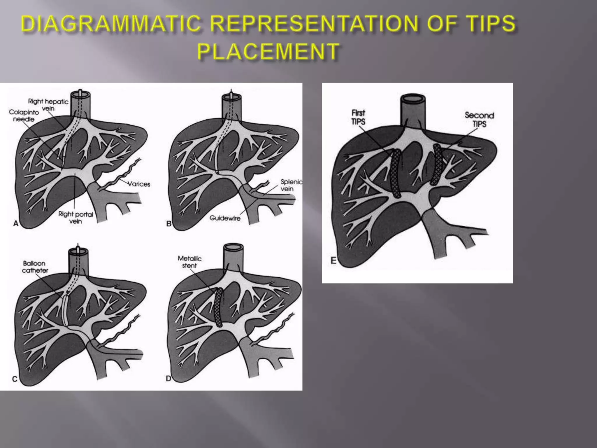 Intervention radiology hepatobiliary system | PPTX