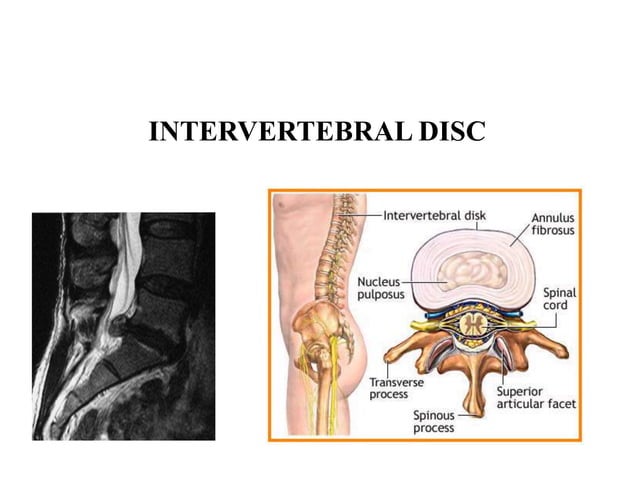 INTERVERTEBRAL DISC AND PROLAPSE OF INTERVERTREBRAL DISC.pptx