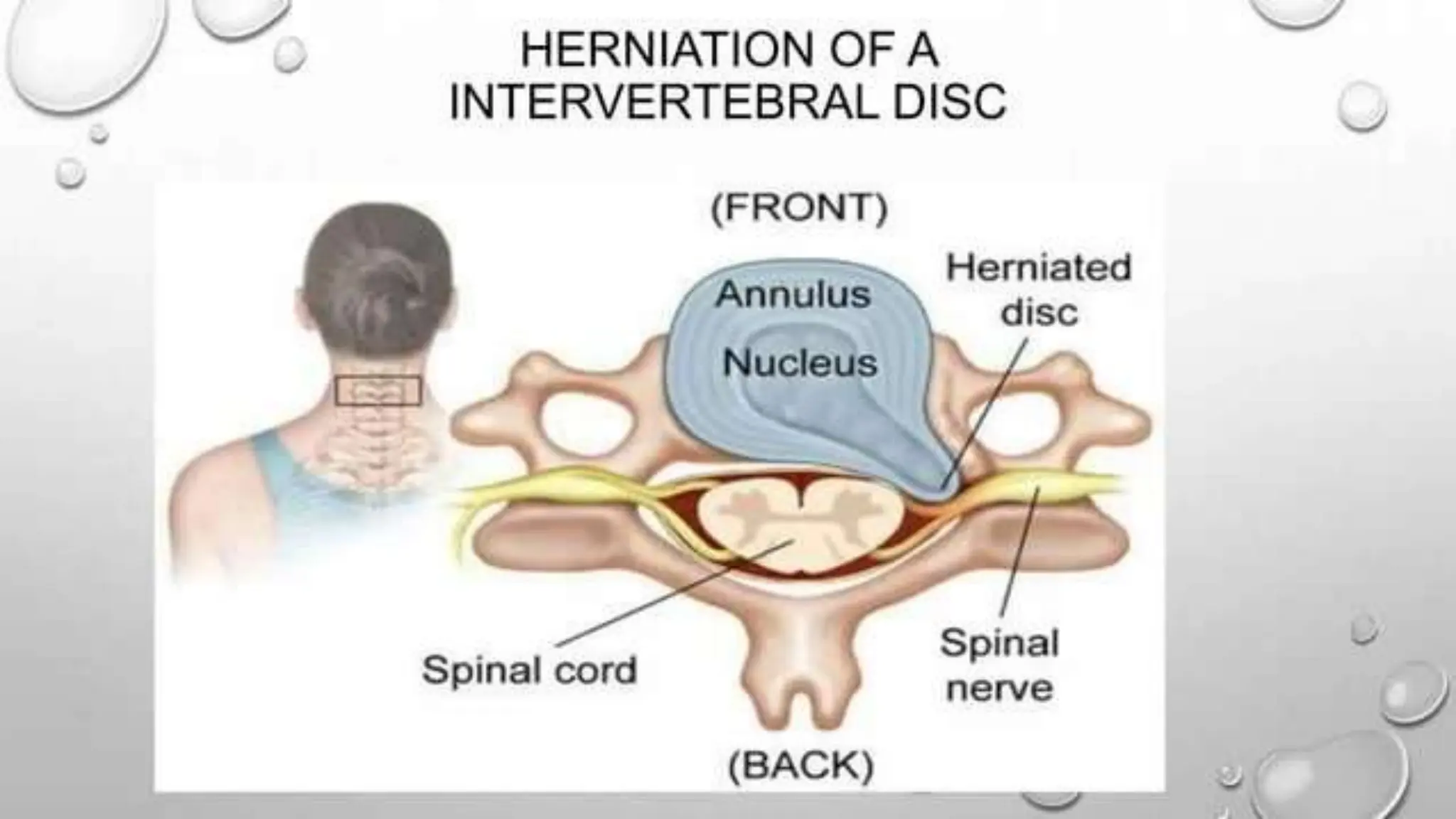 Intervertebral disc herniation trauma.pptx