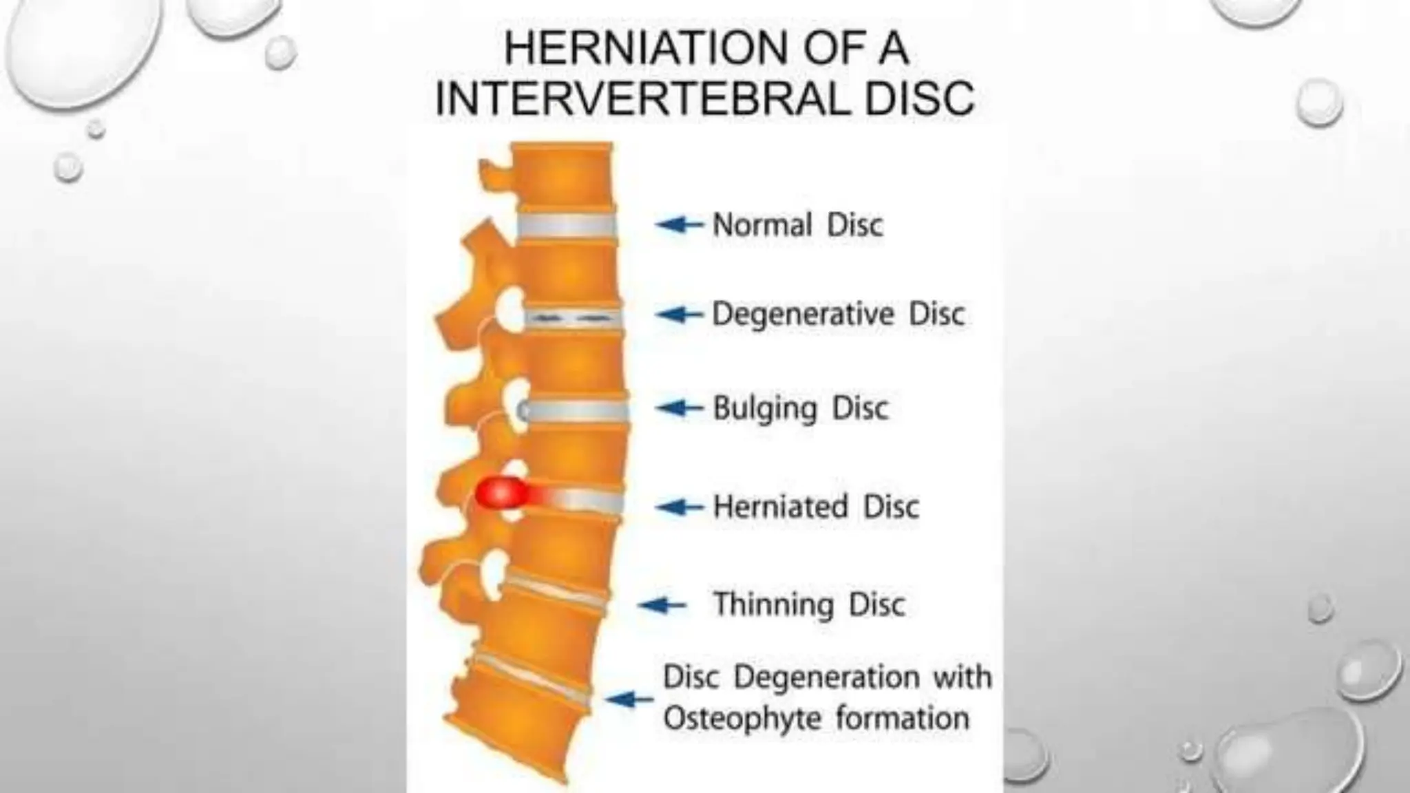 Intervertebral disc herniation trauma.pptx