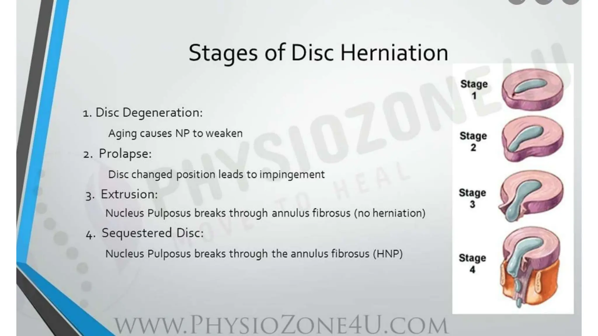 Intervertebral disc herniation trauma.pptx