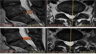 Intervertebral disc herniation trauma.pptx