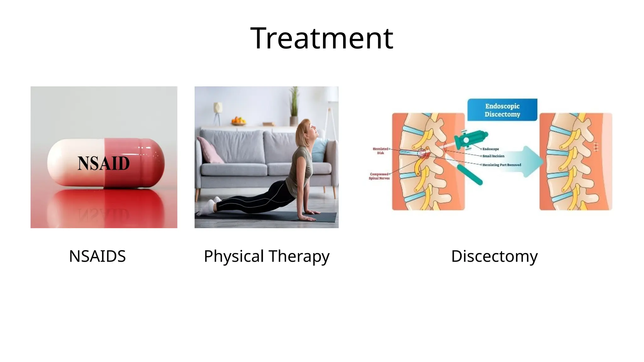 Intervertebral Disc Herniation, it's anatomy | PPTX