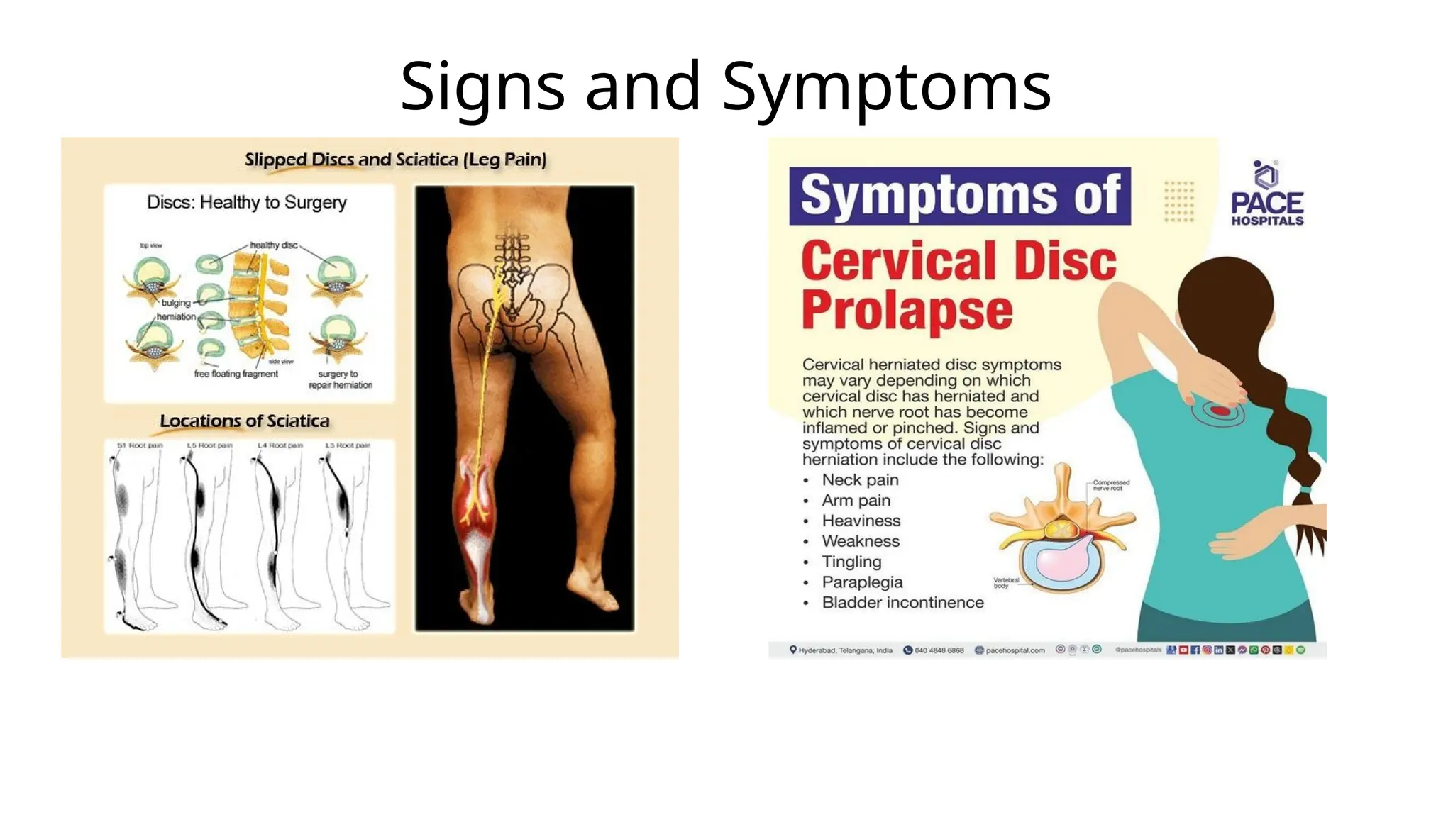 Intervertebral Disc Herniation, it's anatomy | PPTX