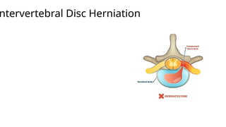 Intervertebral Disc Herniation, it's anatomy | PPTX