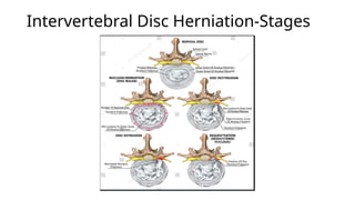 Intervertebral Disc Herniation, it's anatomy | PPTX