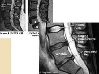 Lumbar Intervertebral disc prolapse | PPTX