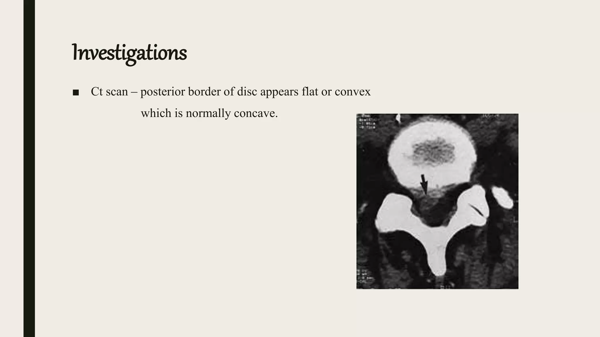 Intervertebral disc prolapse | PPTX