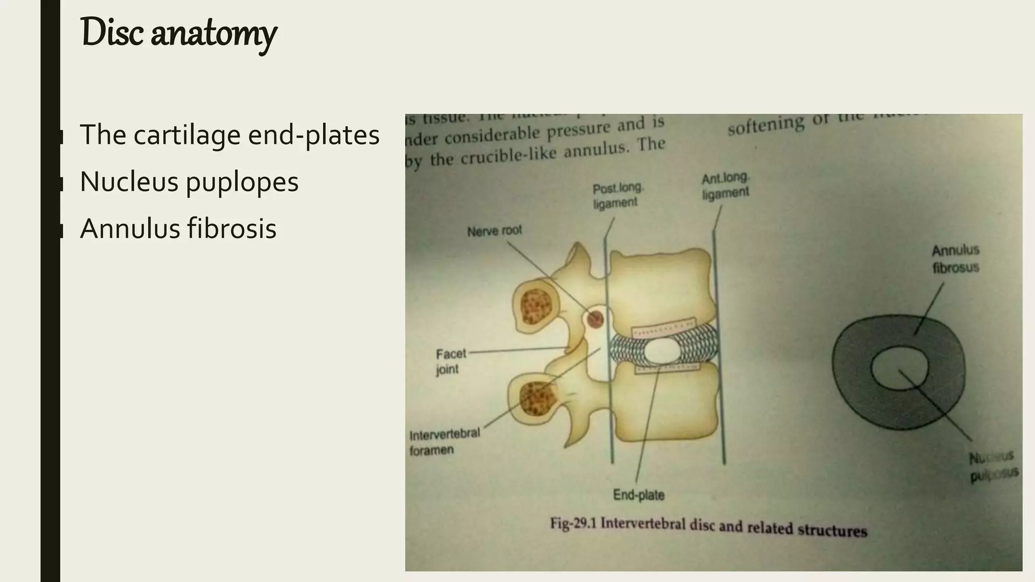 Intervertebral disc prolapse | PPTX