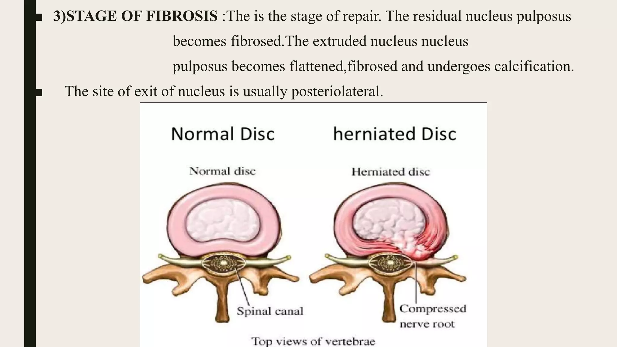 Intervertebral disc prolapse | PPTX