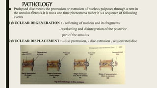 Intervertebral disc prolapse | PPTX